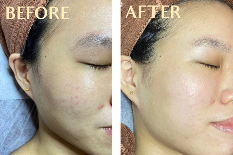 All You Need To Know About Clogged Pores And How To Treat Them ...