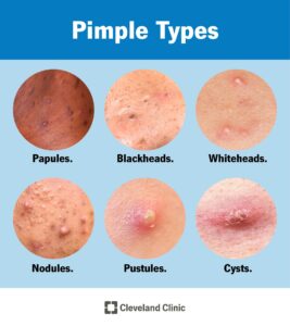 All You Need To Know About Back Acne & How To Treat Them